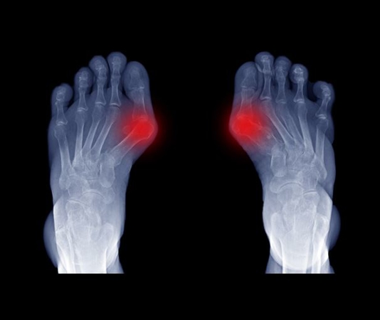 Cartiva Big Toe Joint Implant Complications Blog | Louisville Injury Lawyer